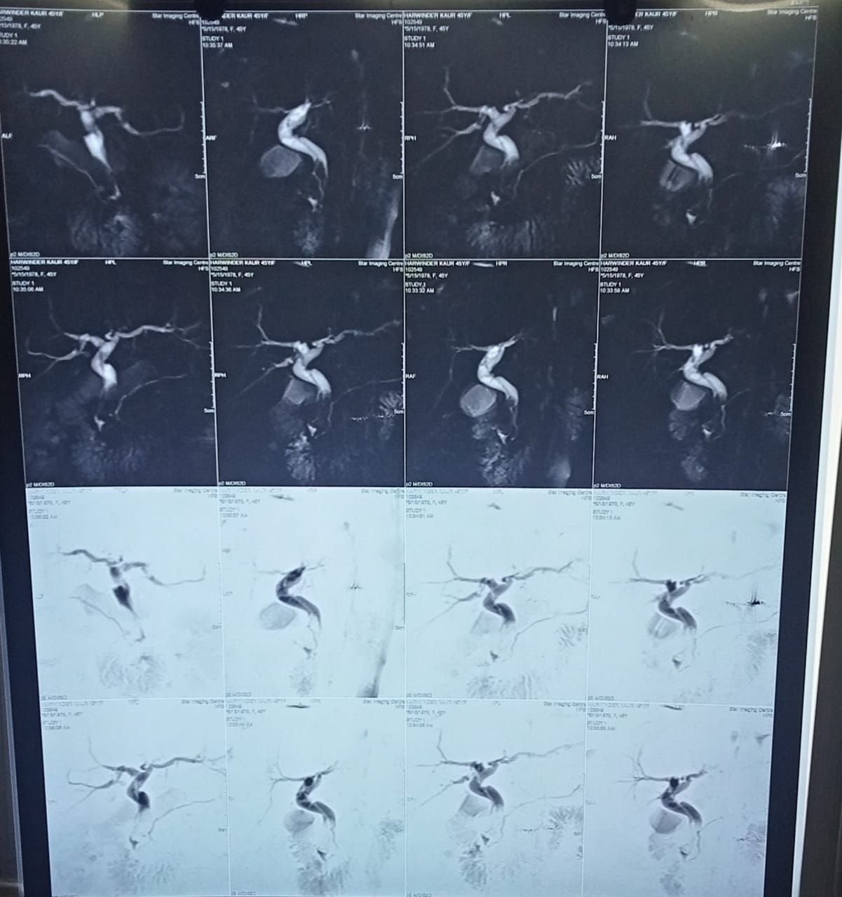 Case of a lady who had failed ERCP with a large CBD stone Removed